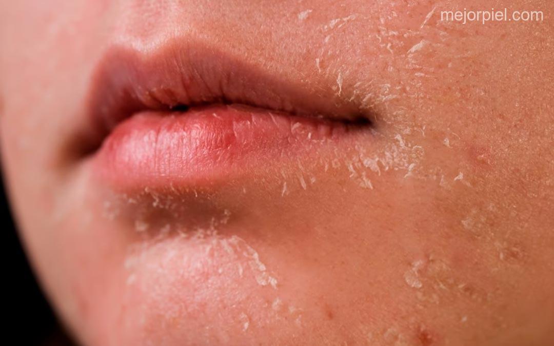 ¿Por qué se descama la piel y cómo solucionarlo? - Mejor Piel